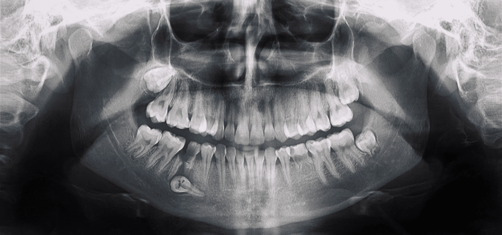 Panoramic X-Rays - The Hills Family Dentistry - Schedule an Appointment ...